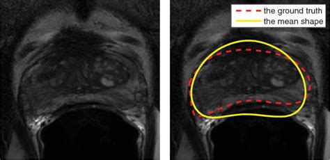 Figure 12 From Prostate Segmentation In Mr Images Using Discriminant