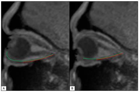 Characterization Of Inferior Rectus Muscle Action In Normal Subjects