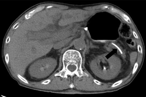 Computed Tomography Revealing The Migrated Pancreatic Stent Arrow At Download Scientific