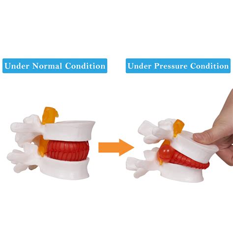 Human Anatomical Lumbar Disc Herniation Model Portable Herniated Lumbar