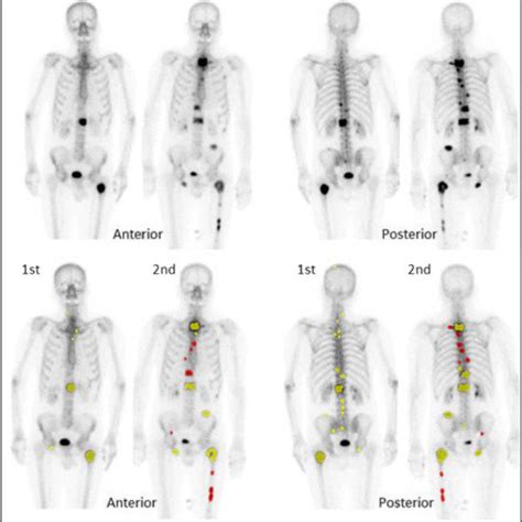 Pdf Progression Of Bone Metastases In Patients With Prostate Cancer