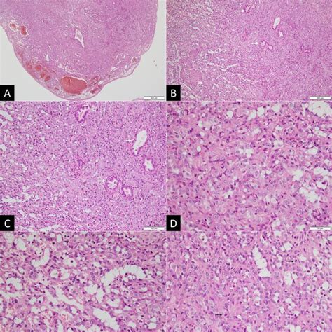 Histopathological Features Tumor Resection Stained For Hematoxylin And