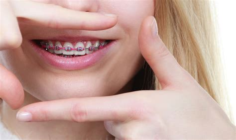 Preventing Teeth Grinding While Wearing Braces