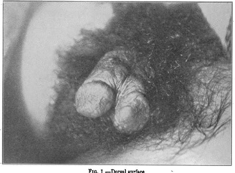 Figure 1 From Note On A Case Of Bifid Penis With Penial Hypospadia