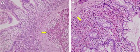 Prominent Eosinophilic Infiltration In The Jejunum Of Case 1 A Download Scientific Diagram