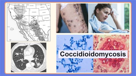 Coccidioides Immitis Infection Coccidioides Fungi Immune Modulation