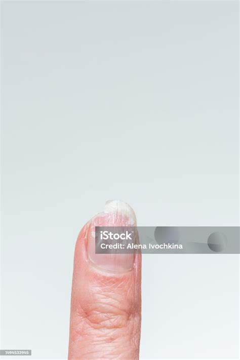 자란 큐티클과 손상된 네일 플레이트가 있는 매니큐어 없이 물고 부러진 손톱을 가진 여자의 손가락 갈고리 발톱에 대한 스톡 사진 및 기타 이미지 Istock