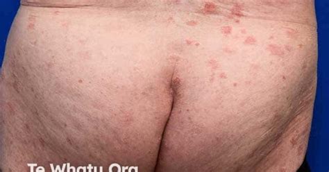 Pityriasis Lichenoides Image