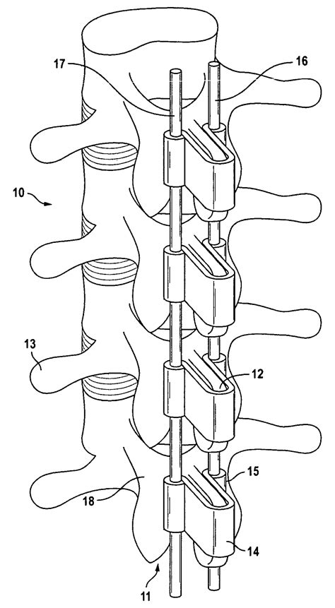 Spinal Deformity Patented Technology Retrieval Search Results Eureka