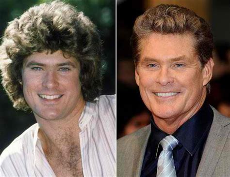 David Hasselhoff Plastic Surgery
