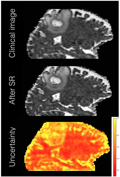Diffusion Tensor Image Super Resolution On A Brain Tumour Patient From