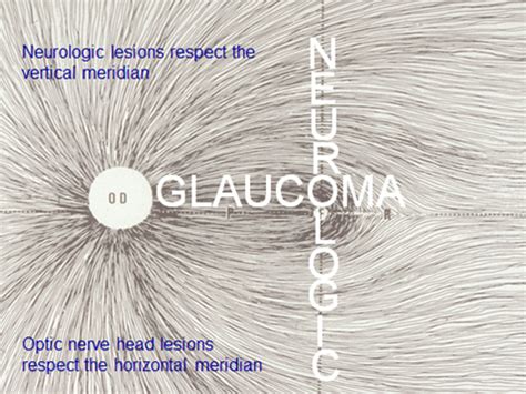 Visual Fields Flashcards Quizlet