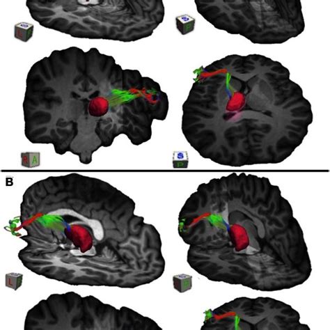 Connections Between Pars Triangularis A And Pars Opercularis B And Download Scientific
