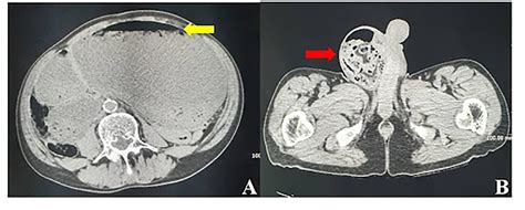 Figure 1 From Jejunal Volvulus Within An Inguinal Hernia Sac Like As An Extremely Rare Cause Of