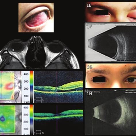 A Diffuse Hyperaemia And Vascular Congestion As A Result Of Anterior