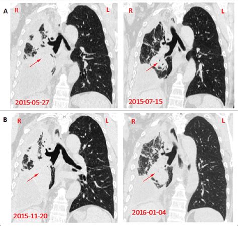 Response To Apatinib Monotherapy And Combination Treatment A Chest