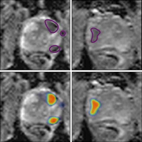 Clinically Significant Prostate Cancer Detection In Bpmri Using Models Trained With Report
