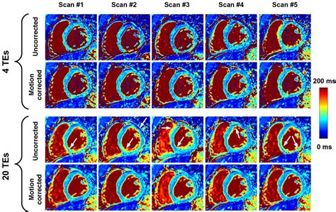Motion Correction For Free Breathing Quantitative Myocardial T2 Mapping Impact On