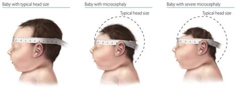 Leanbh Microcephaly