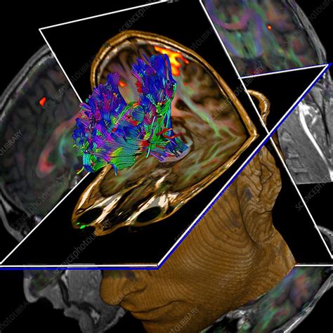 Brain Tumour Dti And Mri Scans Stock Image C0068350 Science