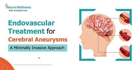 Endovascular Brain Aneurysm Treatment Bangalore Experts