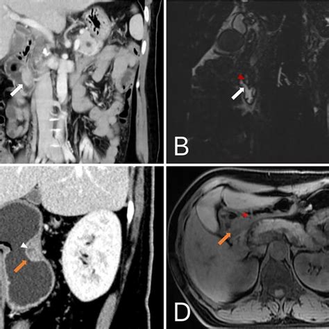 A B A Gist Located In The Lesser Curvature Of Gastric Middle Body Download Scientific Diagram