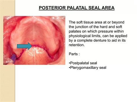 Anatomical Landmarks Of Edentulous Mouth In Complete Denturepptx