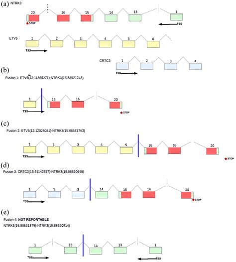 TRK Inhibitor In A Patient With Metastatic Triple Negative Breast Cancer And NTRK Fusions