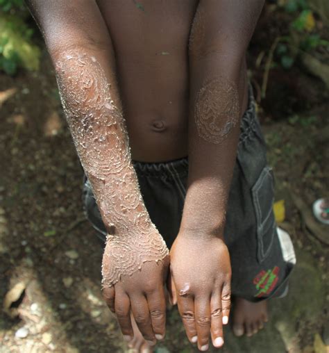 Tinea Imbricata