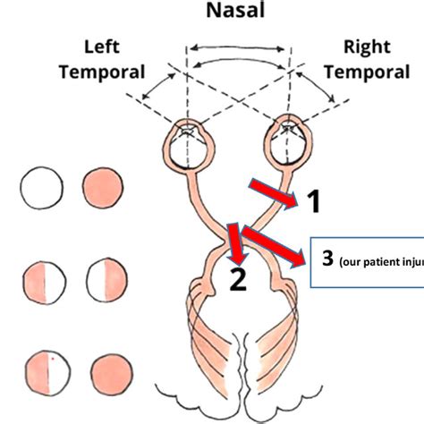 A Axial Ct Scan Showing Absence Of The Right Globe With Diffuse Gas Download Scientific