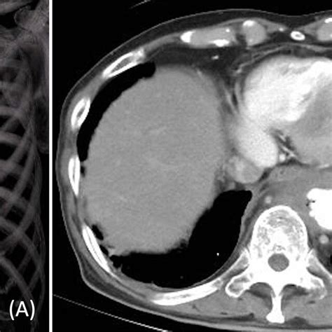 Computed Tomography Ct Before The First Thoracic Endovascular Aortic Download Scientific