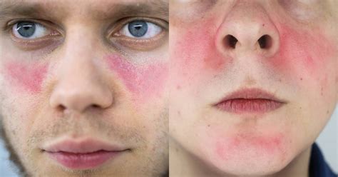Rosacea Vs Lupus Rash Lupus Rash Vs Rosacea Spotting The Key