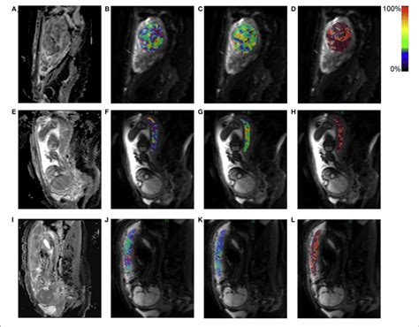 Representative Intravoxel Incoherent Motion Ivim Parametric Maps Download Scientific