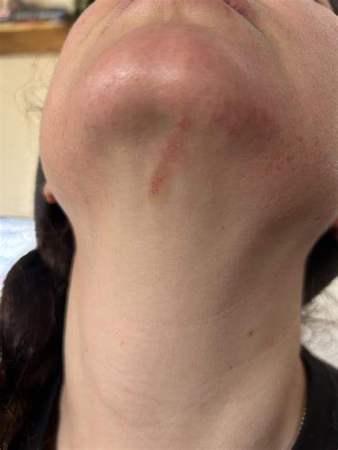 Contact Dermititis Or Scabies R Scabies