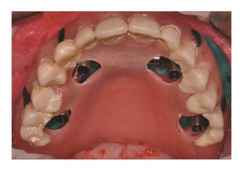 Passive Seating And Occlusal Relationship Of The Removable Prostheses