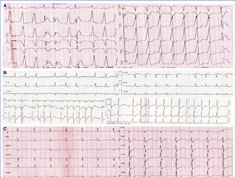 Eletrocardiograma Ecg York A 12 Lead Electrocardiogram Ecg Showing