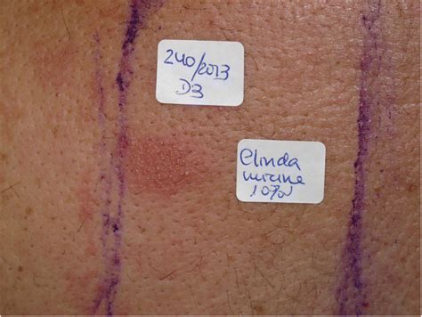 Positive Patch Test To Clindamycin 10 Pet Chemotechnique