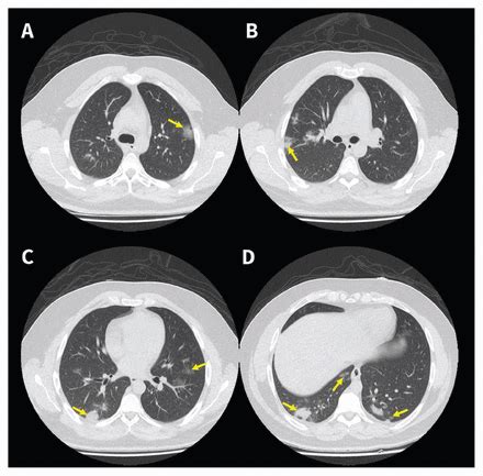 Chest CT Imaging Of An Early Canadian Case Of COVID In A Year Old Man CMAJ