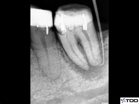 Month Recall On Lower Molar With J Shaped Lucency The Endospot