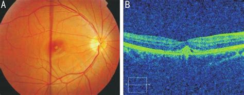 Fifteen Days After Intravitreal Injection Of Conbercept A Fundus