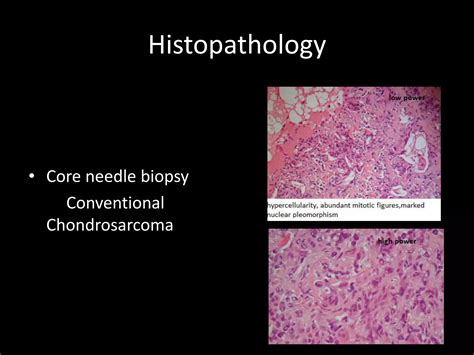 Chondrosarcoma Proximal Humerus Pptx Bone And Joint Conditions