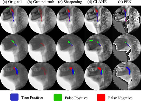 Figure 1 From Peci Net Bolus Segmentation From Video Fluoroscopic