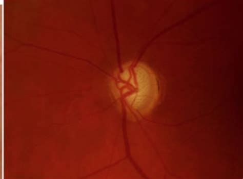 Ocular Anatomy Sclera Flashcards Quizlet