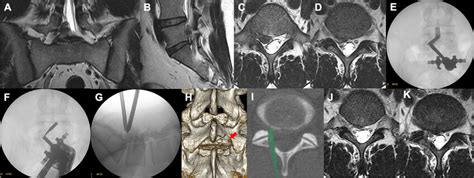 An L5 S1 High Grade Cranially Migrated Disk Herniation Is A Reasonable Download Scientific