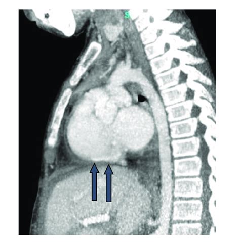 Computed Tomography Revealed Pericardial Thickening And Download Scientific Diagram