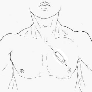 An Anatomic Based Technique For Implantable Loop Recorder Placement Download Scientific Diagram