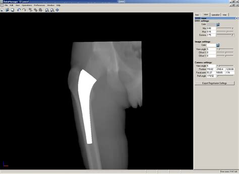 digitally reconstructed radiograph view of a ct scan volume and the