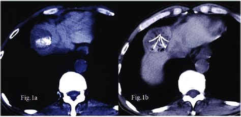 A Transarterial Chemoembolization Plus Multi Imaging Guided Download Scientific Diagram