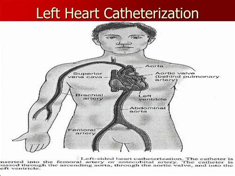 Heart Catheterization Need At Stephen Thompson Blog