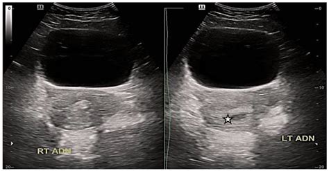 Trans Abdominal Pelvic Ultrasound At 5 Weeks And 5 Days Which Shows An